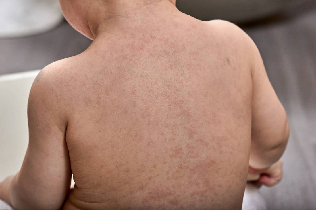 Roseola Rash: Symptoms and Treatment – Happiest Baby